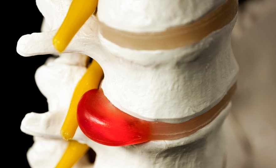Bulging Discs | Legros Chiropractic & Wellness